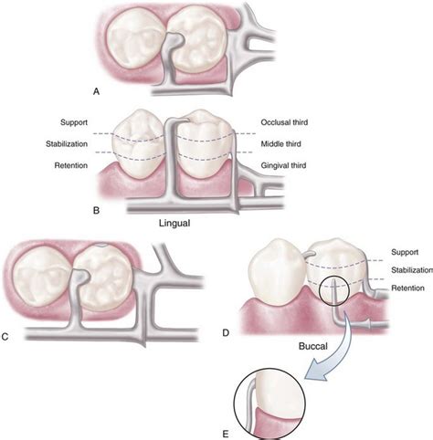 Types Of Suprabulge Clasp At Martin Loya Blog