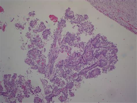 Atlas Of Breast Cancer Early Detection