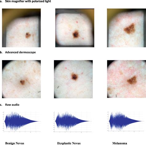 Skin Cancer Detection By Deep Learning And Sound Analysis Algorithms A