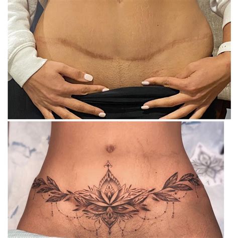 Tummy Tuck Belly Button With Scar Camerafery