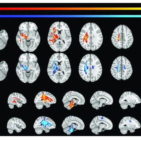 Structural Disconnection Frequency Map 75 Voxels Of White Matter Download Scientific