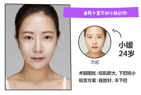 美莱注射瘦脸大众价格注射效果却更好！上海美莱整形医院