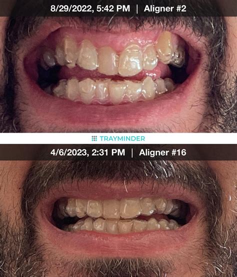 Progress… R Invisalign
