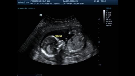 17 Week Ultrasound Youtube