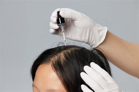 女性脱发治疗护理高清图片下载 正版图片507713756 摄图网