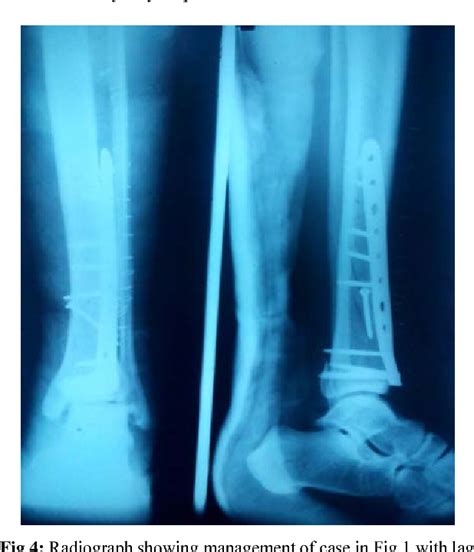 Figure 1 From Management Of Comminuted Distal Metaphyseal Tibial Fractures With 3 5 Mm