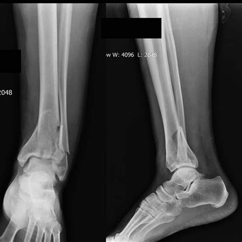 A 30 Year Old Patient With An Intra Articular Distal Tibia Fracture Download Scientific Diagram