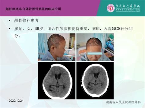 超低温冰冻自体骨颅骨修补的临床应用 脑医汇