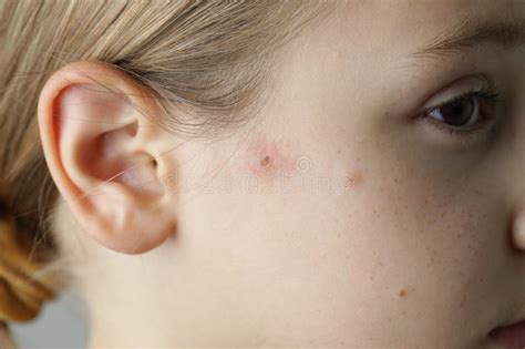 Facial Skin Closeup Allergy Dermatitis Virus Or Bacterial Infection