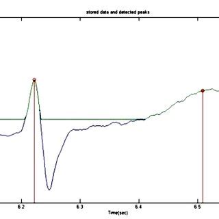 Operation Of The Proposed R Peak Detection Algorithm Download Scientific Diagram