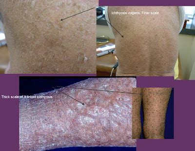 Differential Diagnosis In Dermatology Skin Coloured Scaly Diseases
