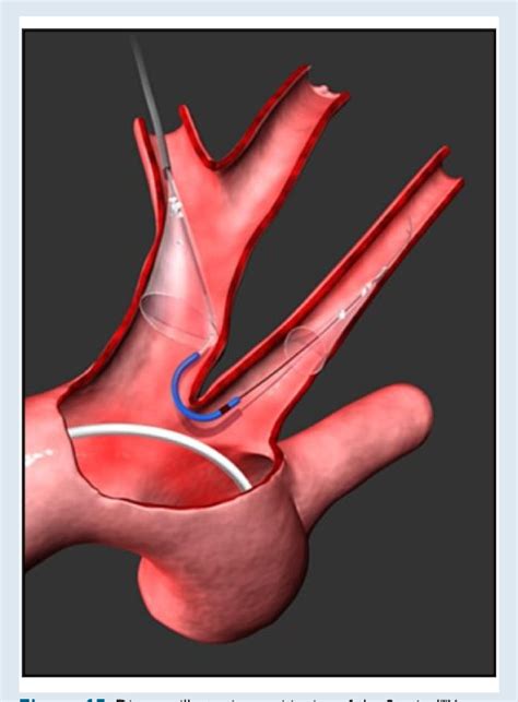 Figure 1 From Practical Guide On Left Atrial Appendage Closure For The Non Implanting Physician