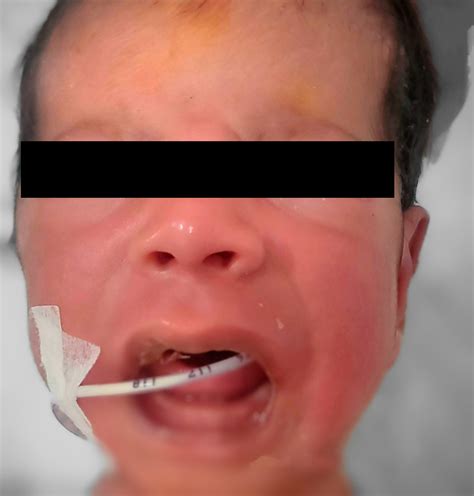 A Neonate With Erythematous Rash Over Face Pediatric Oncall Journal
