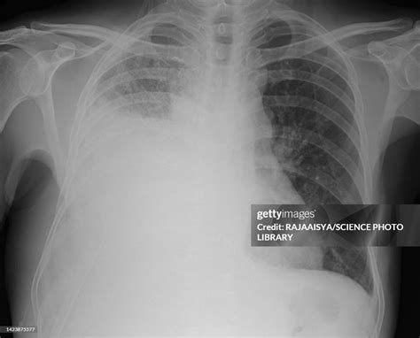 Massive Pleural Effusion X Ray