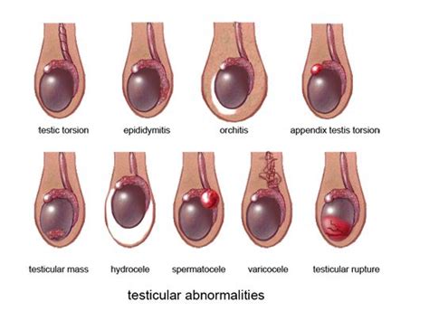 Testicular Abnormalities Andrology Nursing Study Nursing Notes