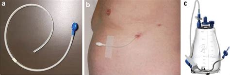 Indwelling Pleural Catheter This Leaflet Has Been Provided To Answer