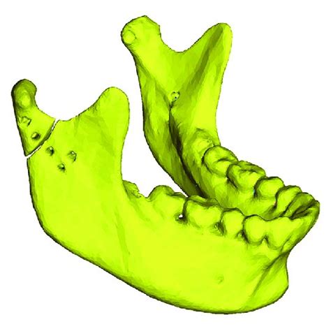 Finite Element Model Of Human Mandible With A Simulated Condylar