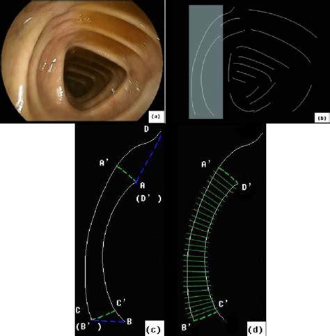 Quasi Parallel Edge Detection A A Non Dark Colon Lumen Image B