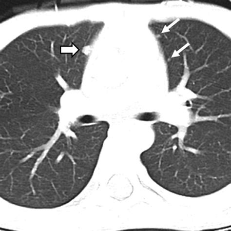 Axial CT Images Of The Chest Lung Window Demonstrates Well Defined