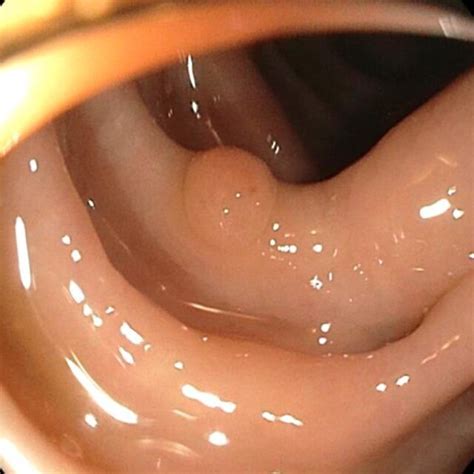 11 The Nbi International Colorectal Endoscopic Nice Classification Download Scientific