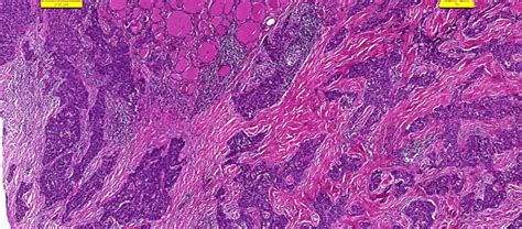 Carcinoma Showing Thymus Like Differentiation CASTLE A Rare Tumor Of