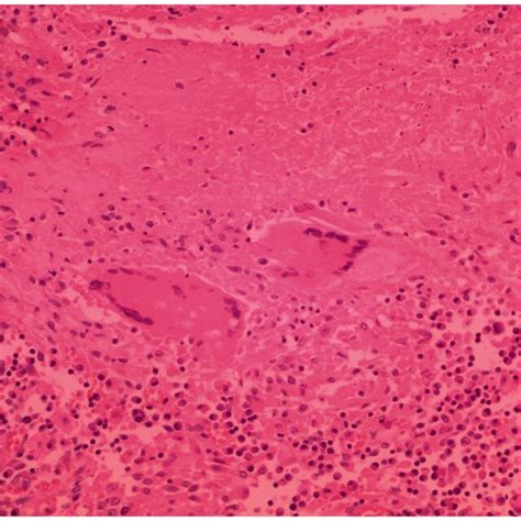 Histopathological Examination Findings Hematoxylin And Eosin Hande