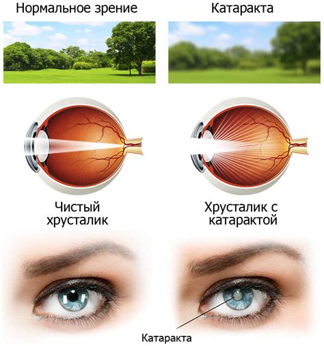 Лечение катаракты Офтальмологический центр Добрый взгляд