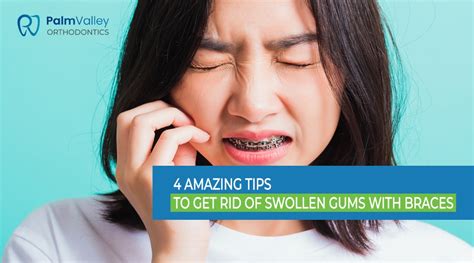 Tips To Prevent And Treat Swollen Gums With Braces