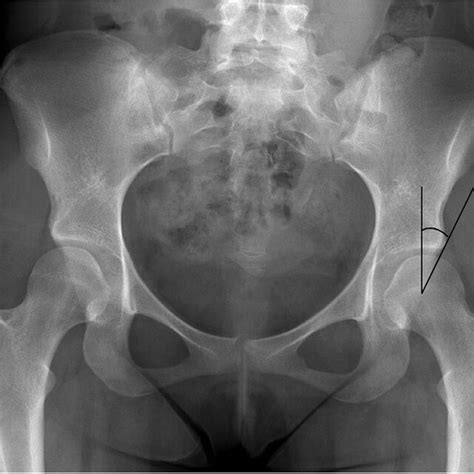 Anteroposterior Radiographic Image Of A Pelvis Demonstrating Left Hip