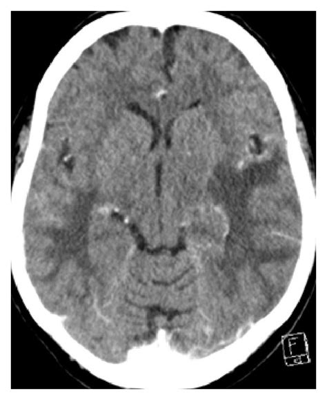 Contrast Enhanced Ct Brain Showing Bilateral Vasogenic Edema Of The
