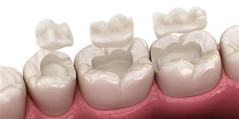 Advantages Of Nano Ceramic Composite Prevest Direct