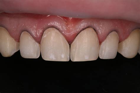 Perfectly Prepped 7 Reasons To Open Interproximal Contacts In