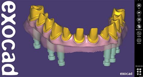ExoCad Library Available Now TOV Implant Blog Officiel