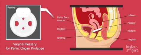 Pelvic Floor Repair Surgery Recovery And Alternatives Ryc®