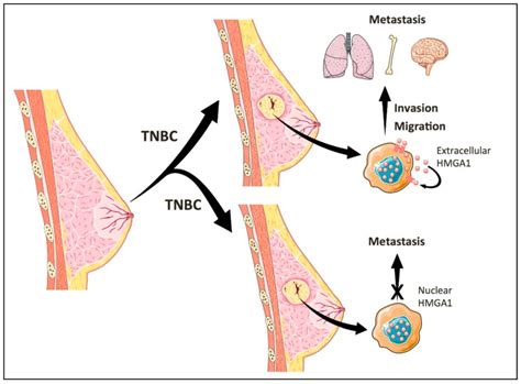 Clinical Implications Of Extracellular Hmga1 In Breast Cancer Pmc