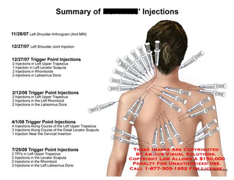 Upper Back Trigger Points Chart Ponasa