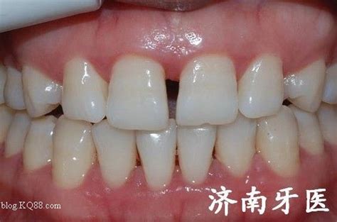 树脂修复前牙间隙及改形 国洪波的博客 KQ88口腔博客