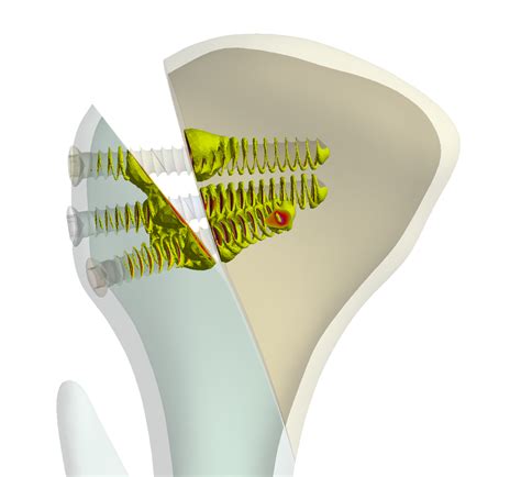 The Science Behind A Healing Jaw Finite Element Analysis Of Mandibular Osteosynthesis Simq
