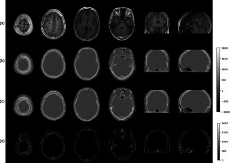 Comparison Of A T1‐weighted Tirm Dark Fluid Mri B Synthetic