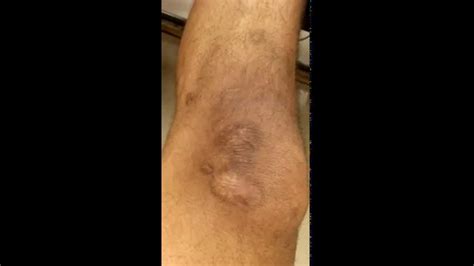 One Year After Mrsa Staph Infection Surgery Youtube