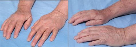 Figure 1 From Work Related Upper Limb Disorders A Case Report