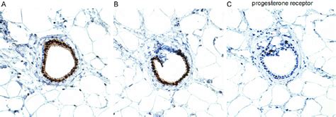 Normal Luminal Epithelium In The Same Duct Showing Diffuse 100