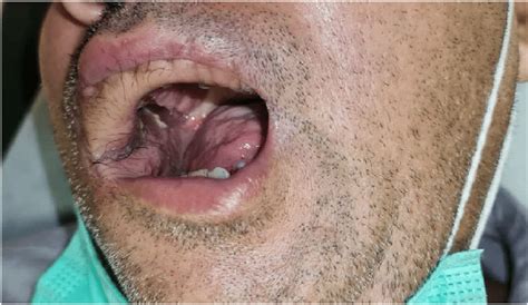 Reconstruction After Wide Excision Download Scientific Diagram