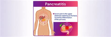 7 Early Pancreatitis Warning Signs You Should Never Ignore