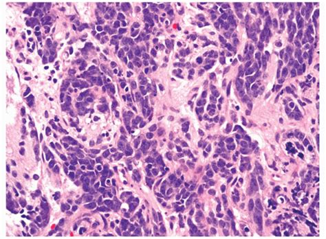 Germ Cell Tumors Basicmedical Key