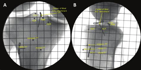 A Anteroposterior And B Lateral Radiographic Views Demonstrating