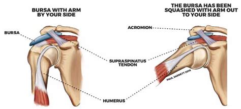 What Is Bursitis Sports Medicine Clinic