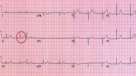 Cardiac Arrhthmia Pathophysiologytreatmentpptx