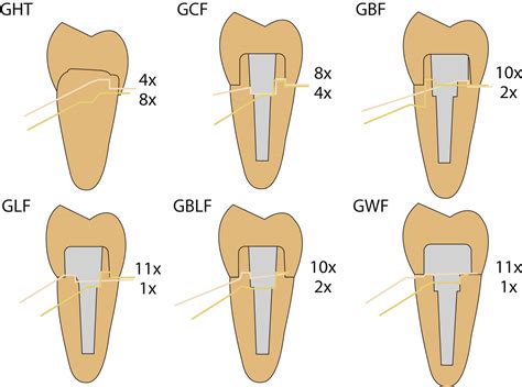 Effect Of Ferrule Location On The Fracture Resistance Of Crowned Mandibular Premolars An In