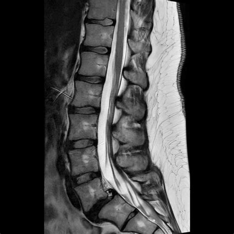 10 Weeks Pregnant With Herniated Disk Rsciatica